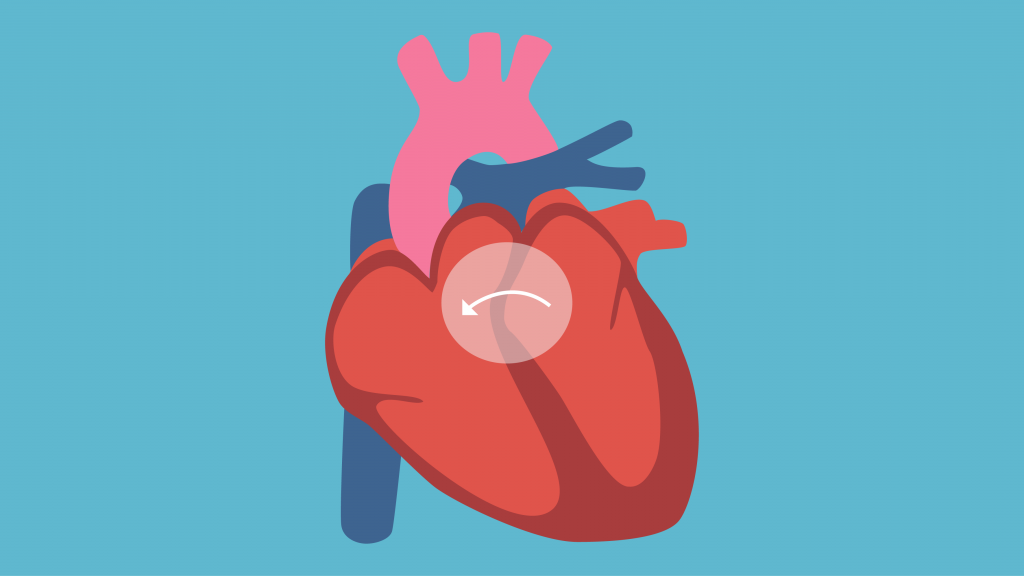 Les malformations cardiaques congénitales – Docteur V